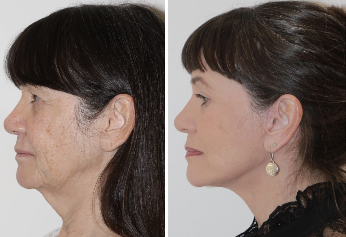Deep Plane Facelift Surgery Approach London UK | Rajiv Grover