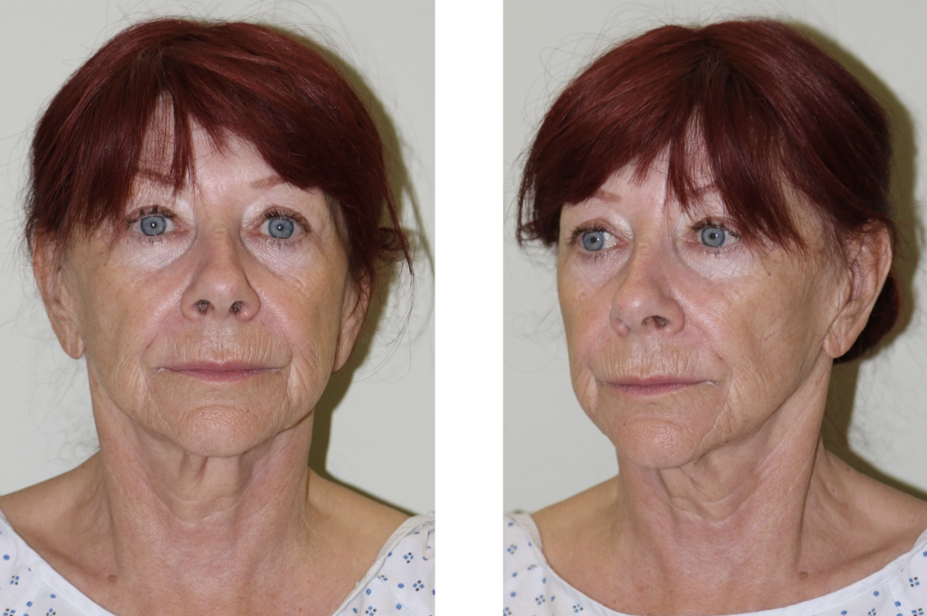 Deep Plane Facelift Surgery Recovery London UK | Rajiv Grover