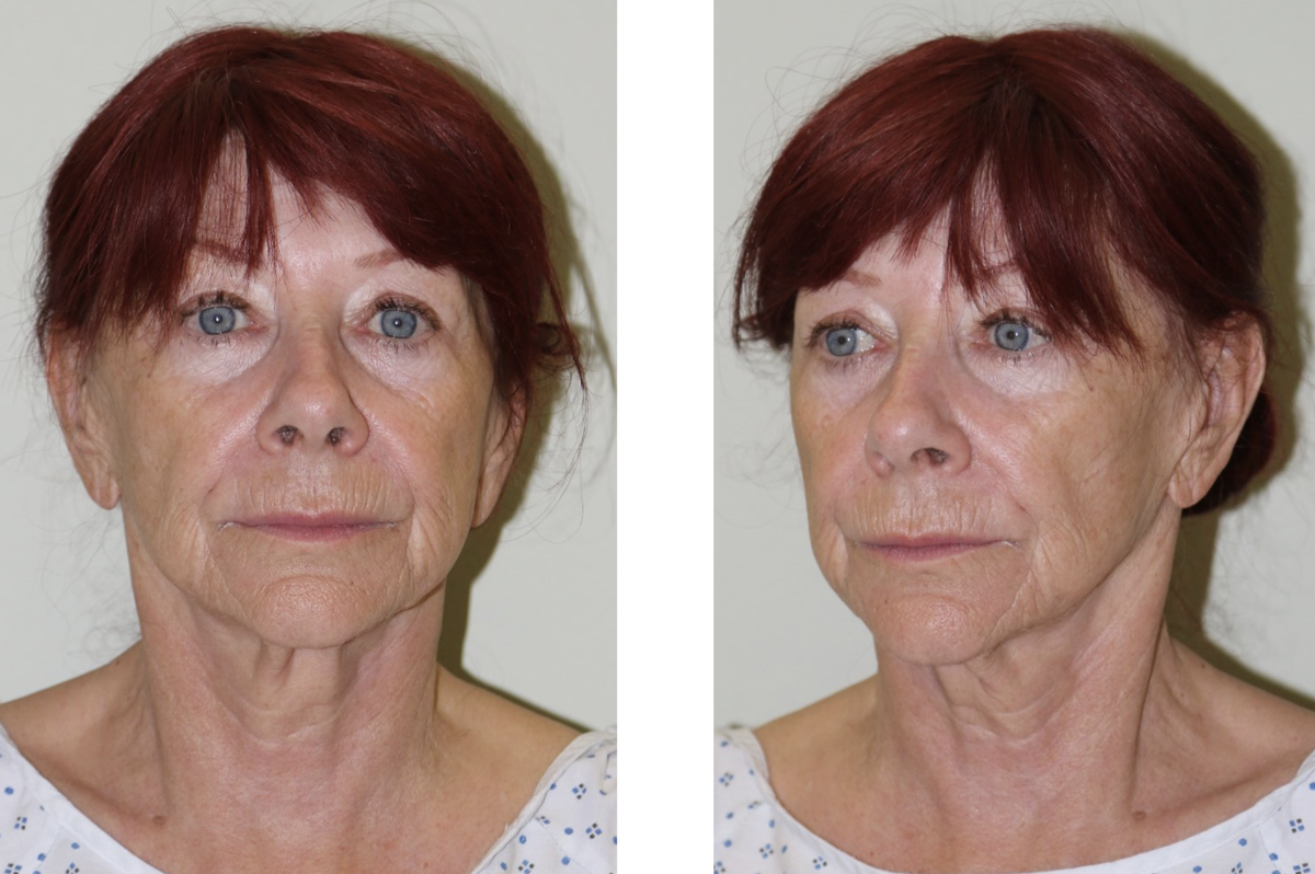 Deep Plane Facelift Surgery Recovery London UK | Rajiv Grover