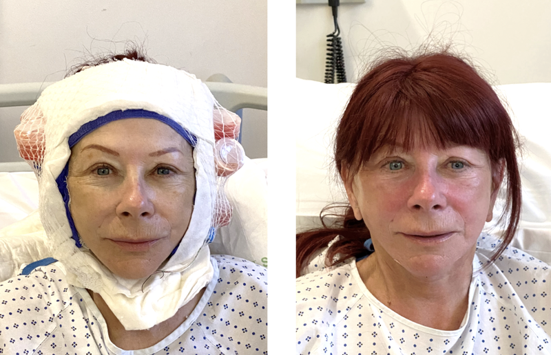 Deep Plane Facelift Surgery Recovery London UK | Rajiv Grover