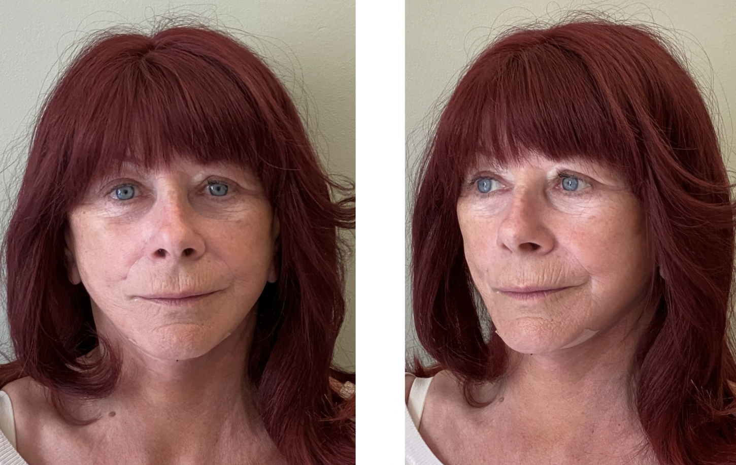 Deep Plane Facelift Surgery Recovery London UK | Rajiv Grover