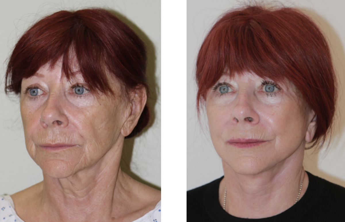 Deep Plane Facelift Surgery Recovery London UK | Rajiv Grover
