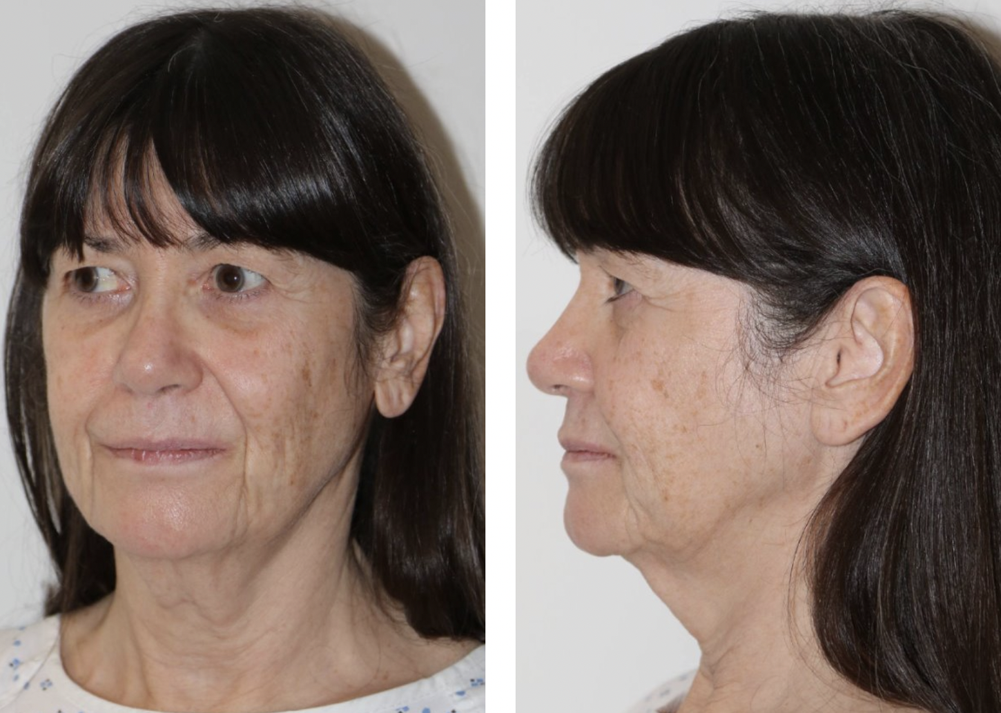 Deep Plane Facelift Surgery Recovery London UK | Rajiv Grover